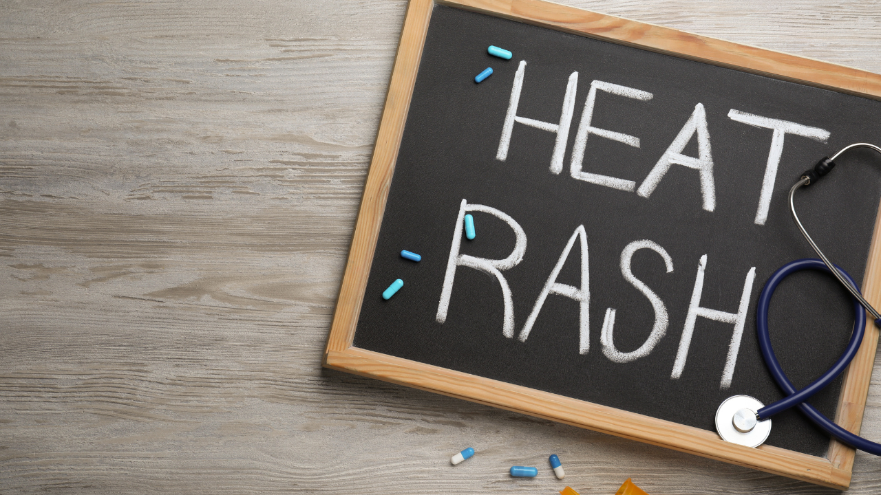 Heat rash: how to spot it & what to do